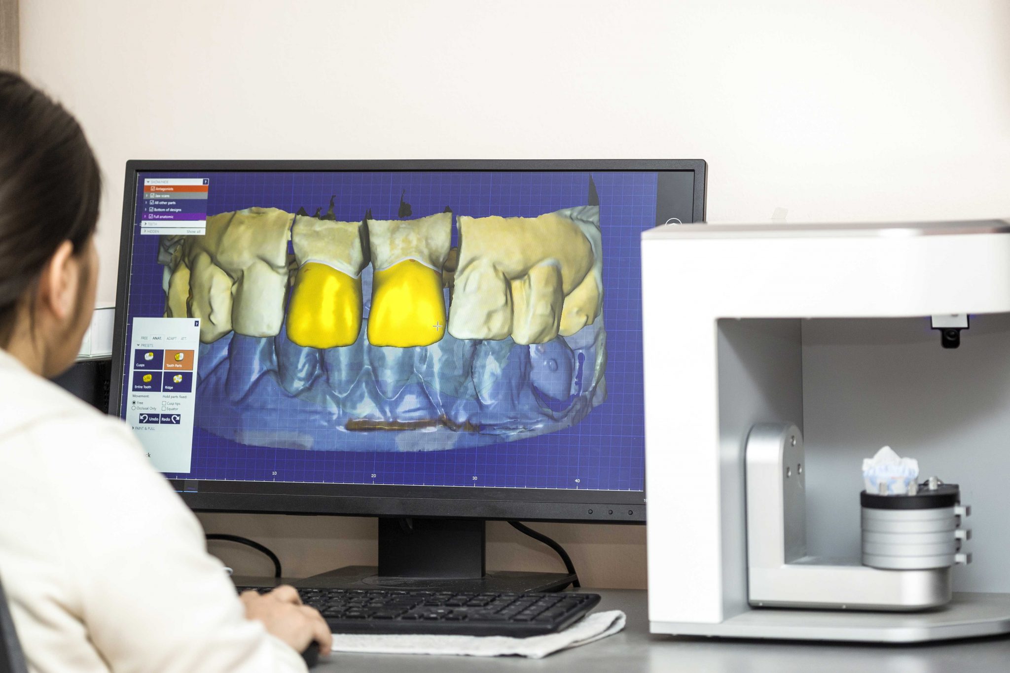 Intraoral Scanner in Berlin, MD - OC Pearl Family Dental